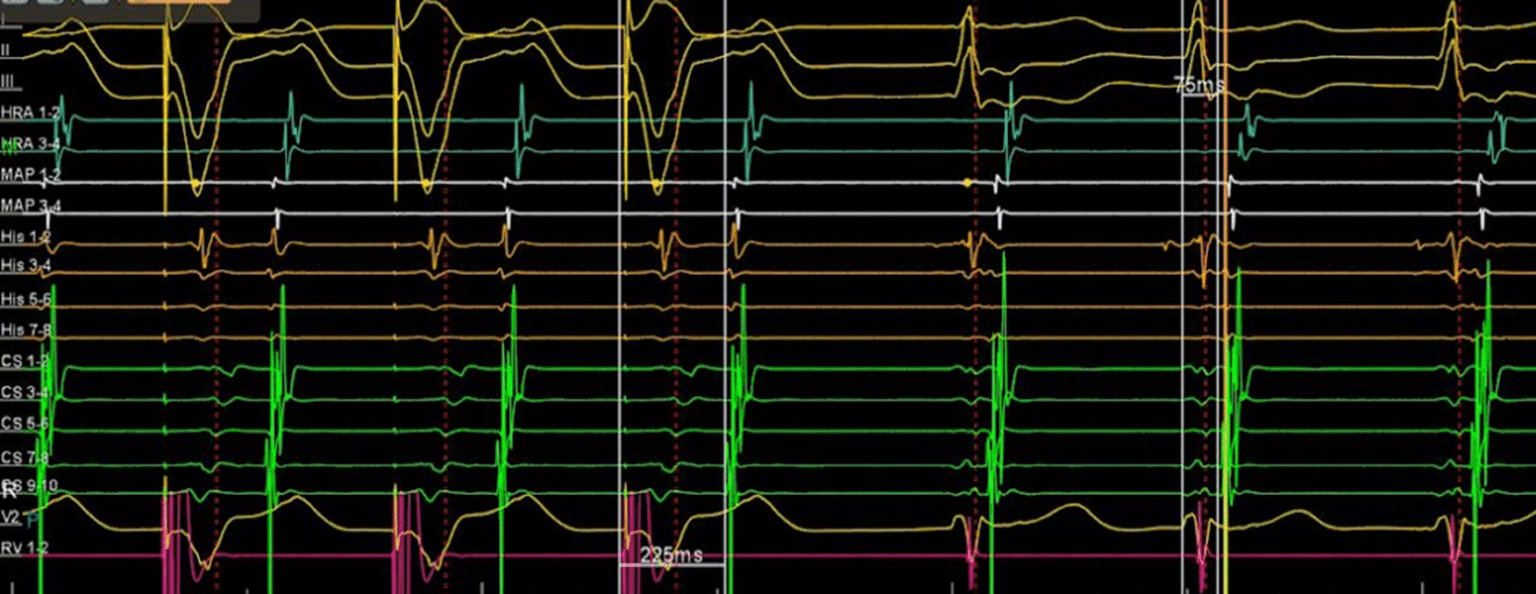 Unpacking SA-VA for SVT: How it Works, When it Doesn't & some ...
