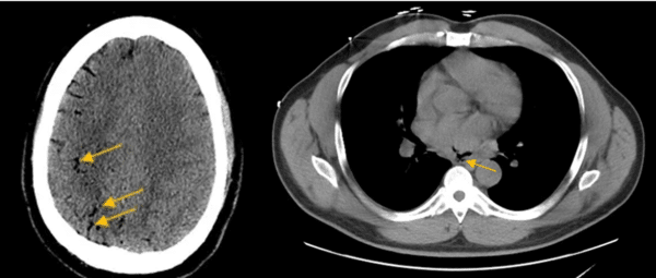 An unwanted connection: Complication of AF Ablation - Cardiac ...