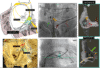 Anatomy Spotlight: Triangle of Koch - Cardiac Physiology in Practice