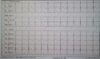 Localising Accessory Pathways using the ECG - Cardiac Physiology in ...