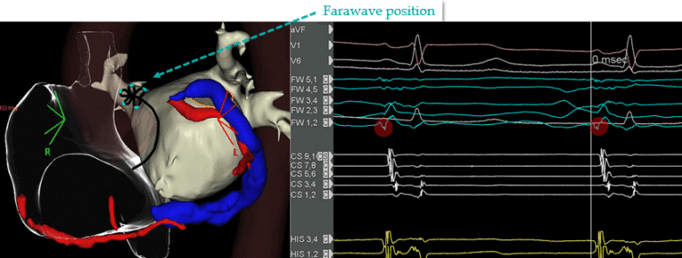 PV entrance conduction or Far Field potentials? - Cardiac Physiology in ...