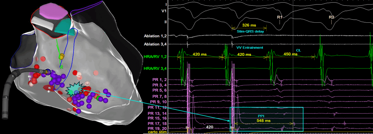VT Entrainment interpretation - Cardiac Physiology in Practice