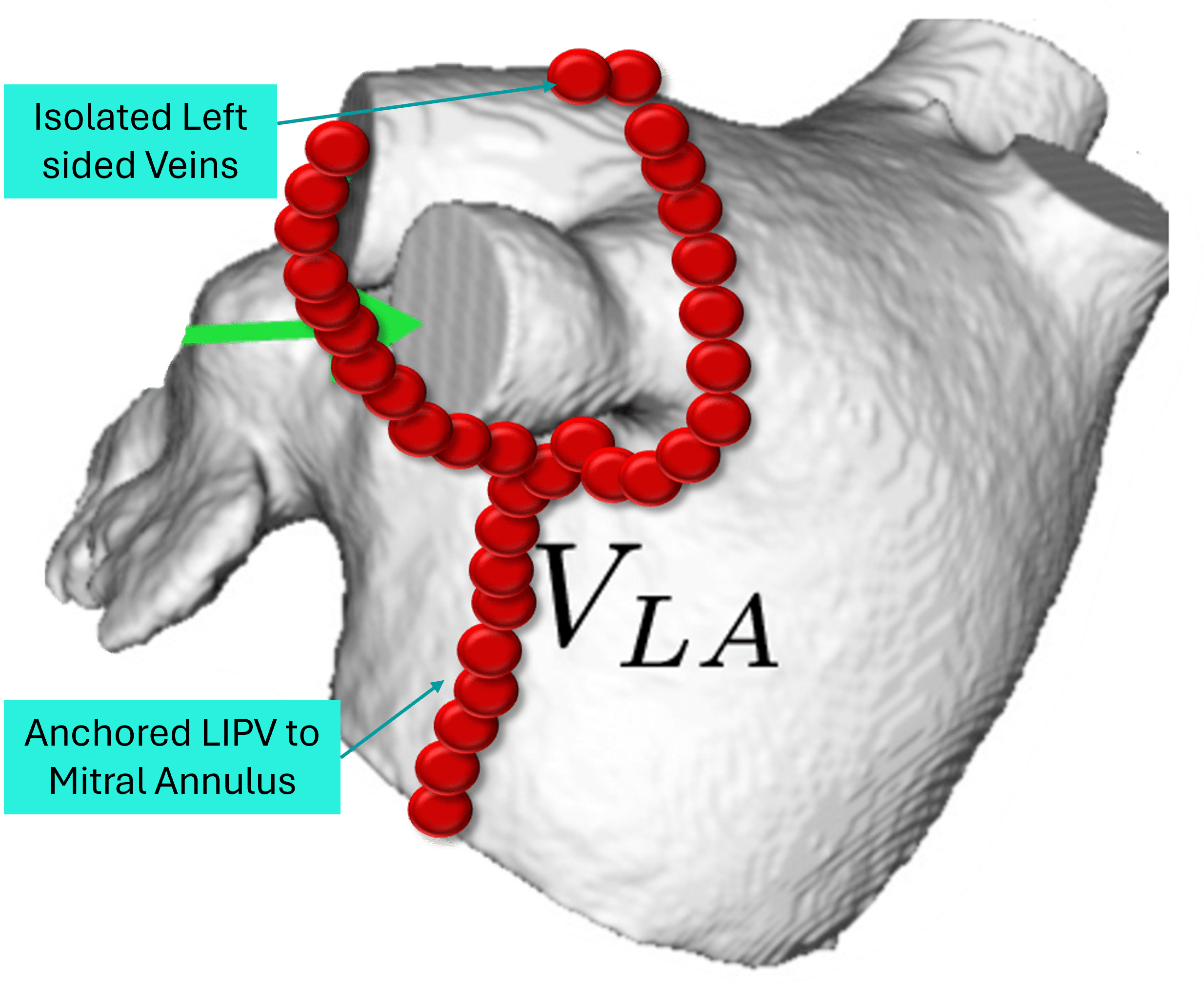 Blocking Posterolateral Mitral Lines - Cardiac Physiology in Practice