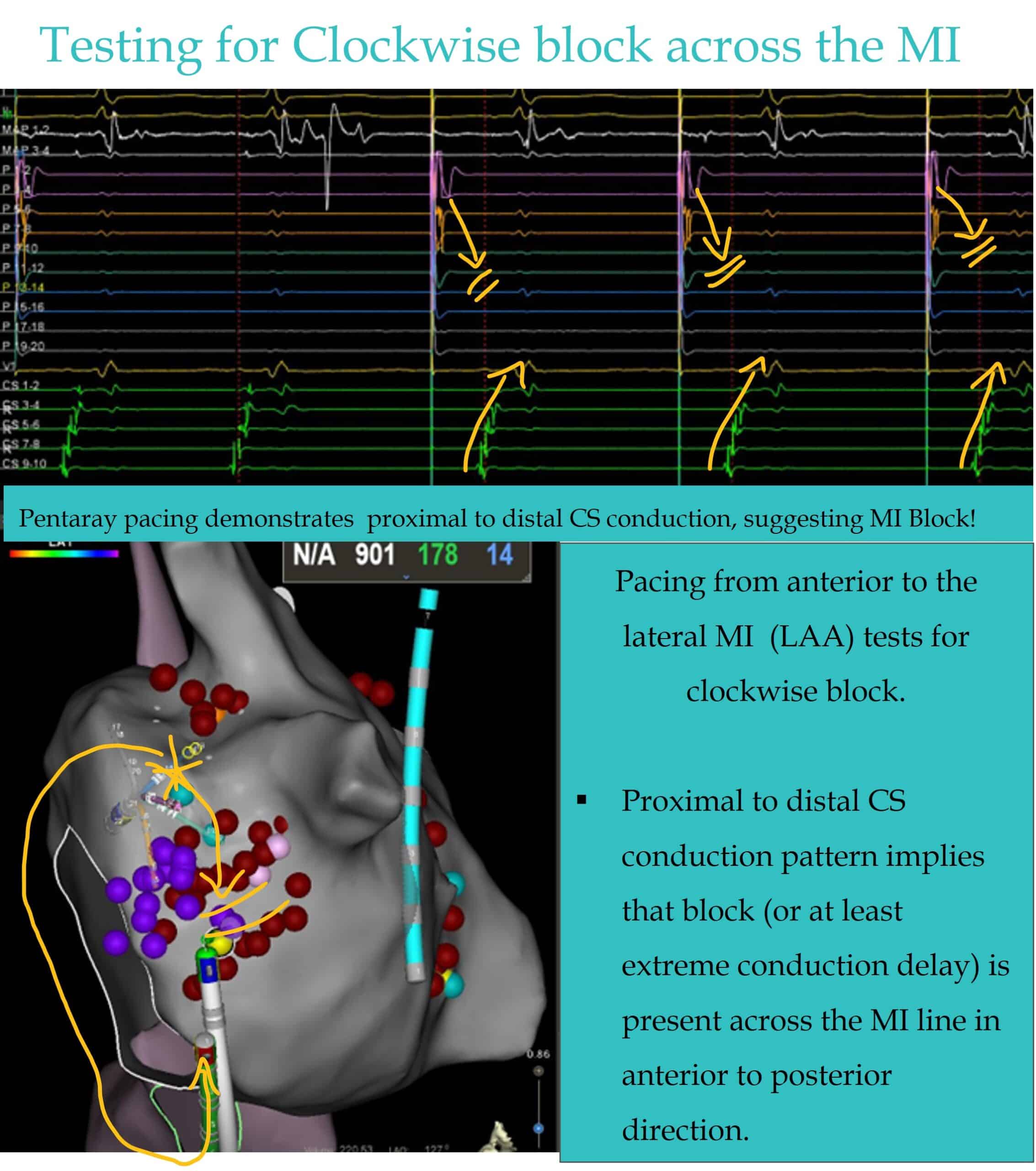 Blocking Posterolateral Mitral Lines - Cardiac Physiology in Practice