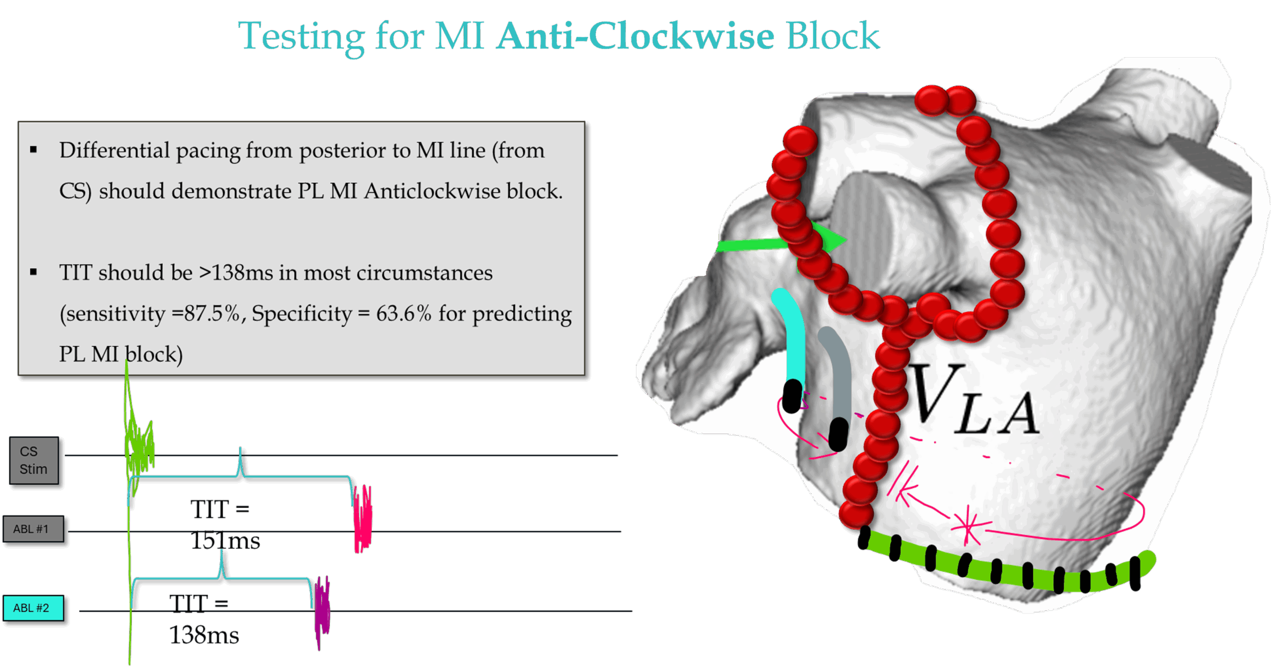 Blocking Posterolateral Mitral Lines - Cardiac Physiology in Practice